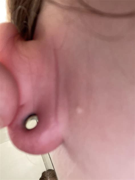 Ear Swollen Over Plug I Dont Know What To Do Scrolller