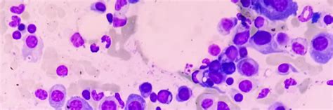 Impact Of Prior Therapies And Risk Factors On Aml Transformed From Mds