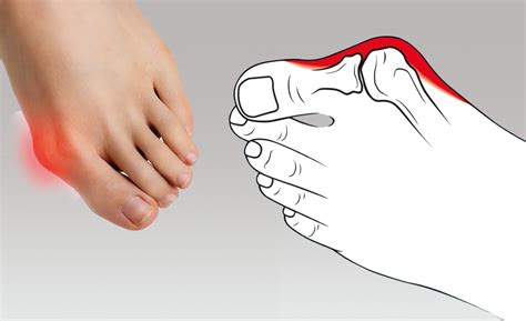 Hallux Valgus Apm Indaiatuba
