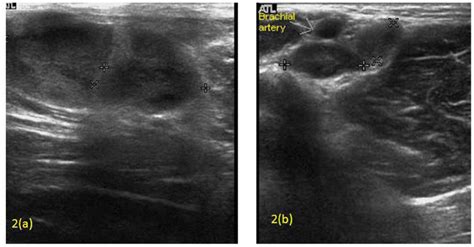 Structure Of Epitrochlear Lymph Node Semantic Scholar