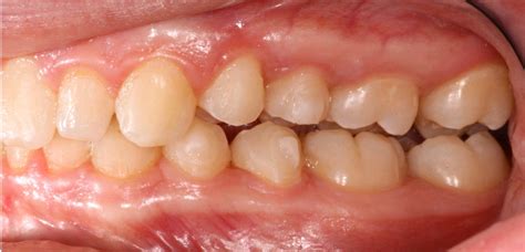 How To Correct Posterior Open Bite After Invisalign