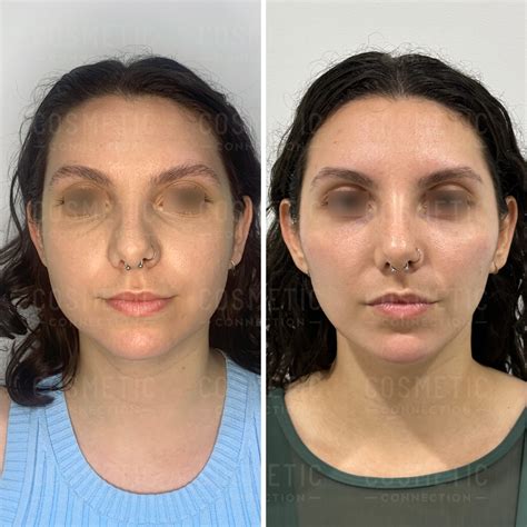 How To Get A V Shaped Face Without Surgery Cosmetic Connection