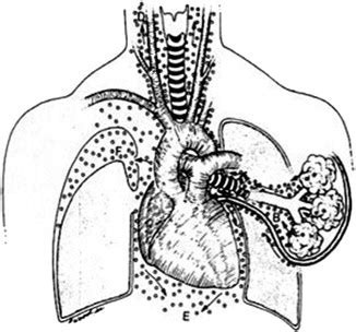 Spontaneous Pneumomediastinum And Subcutaneous Emphysema In Asthma
