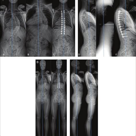 Patient Presenting With A Lenke Type A Curve On The AP Standing Download Scientific Diagram