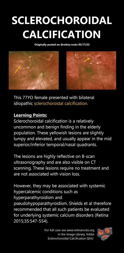 Neoplastic Choroid Disorders Sclerochoroidal Calcification Retina Rocks