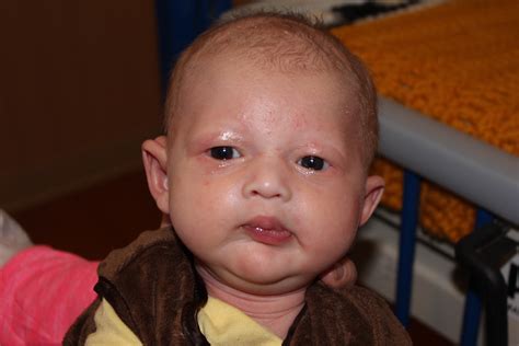 Why I Volunteered To Participate In The Edimer Research Trials Nfed