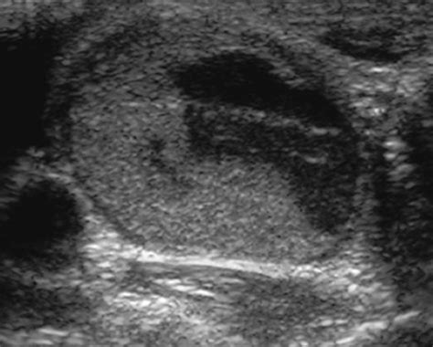 Medullary Carcinoma Thyroid Ultrasound Medullary Thyroid Carcinoma An