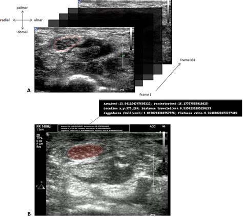 Fig 4 A Example Of An Ultrasound Image Manually Segmented Red