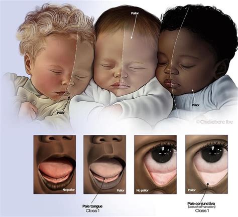 Classification Of Normocytic Anaemia Acute Vs Chronic Normocytic Anaemia Klarity Health Library