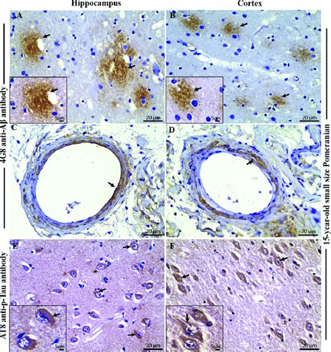Immunohistochemical Staining With 4g8 Anti A And At8 Anti Ptau Antibody