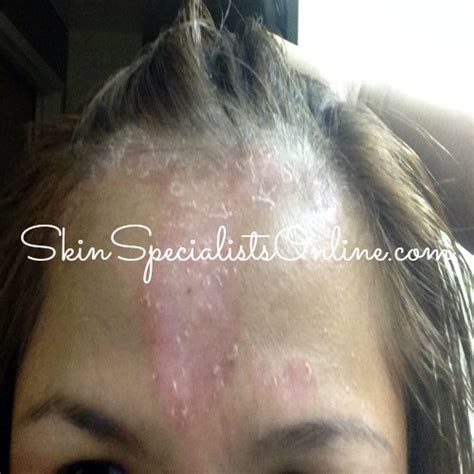 Dry Scalp Causes And Treatment Skin Specialists Online