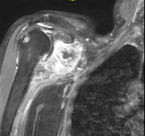 Chondrocalcinosis Shoulder