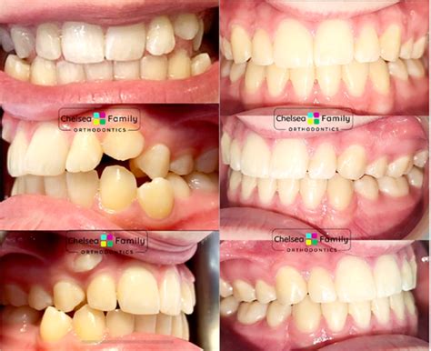 Twin Block Appliance In Chelsea Sw3 Dental Specialist Orthodontist