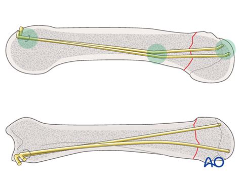 Intramedullary K Wire Fixation For Extraarticular Fracture Of The Distal End Segment