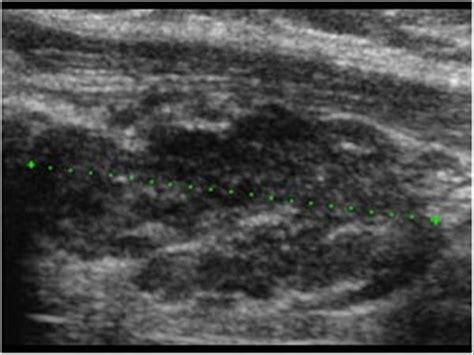 Head And Neck 4 1 Thyroid Gland Case 4 1 4 Thyroiditis And Diffuse