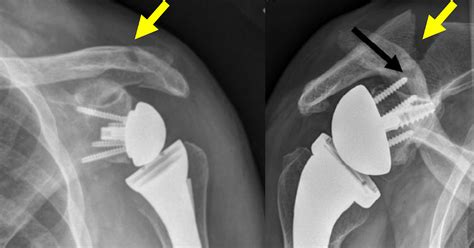 Uw Shoulder And Elbow Academy Risk Factors For Acromial And Scapular Spine Fractures Are We