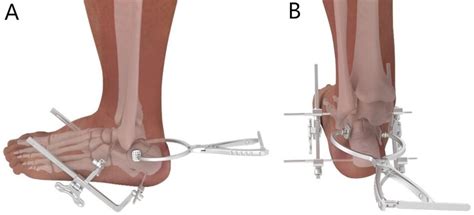The Traction And Reduction Tools For Calcaneous Fracture A Lateral View Download Scientific