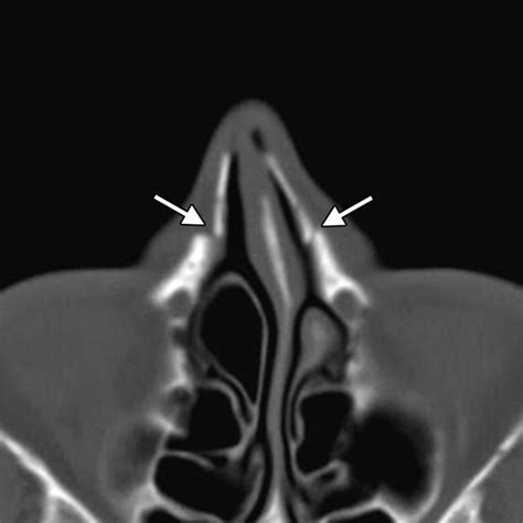 Lateral Osteotomy Axial Ct Image Shows Defects In The Bilateral Nasal