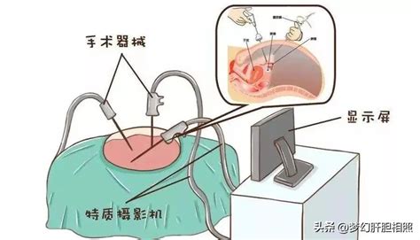什么是微创无痛手术 说明书网