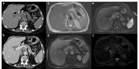 Tumor Recurrence Dwi Value 69 Year Old Female Patient During Routine