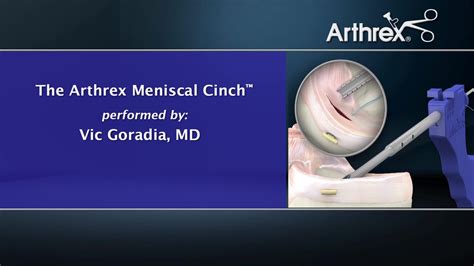 Arthrex The Arthrex Meniscal Cinch™
