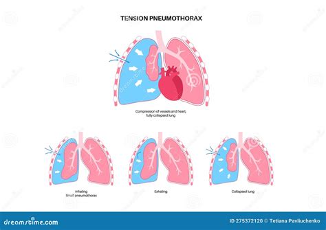 Tension Pneumothorax Poster Vector Illustration