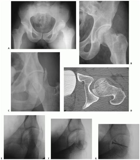 Dip Dislocation Teachme Orthopedics