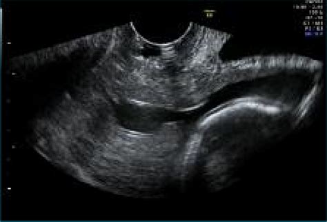 Transvaginal Ultrasound At 21 Weeks And 2 Days Cervix With A Length Of