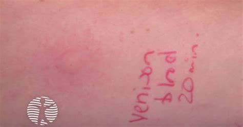 Contact Urticaria Image