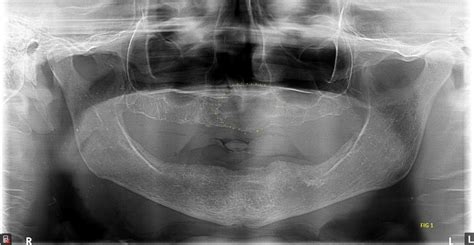 Caso 41 Quiste Residual Radiodontica
