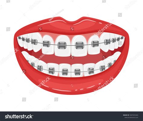 Open Mouth Braces On Teeth Straight Stock Vector Royalty Free