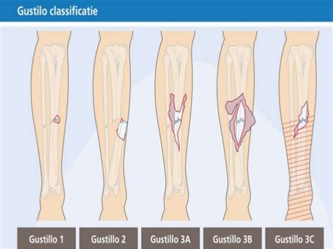Classification Of Fractures And Compound Fracture Managment