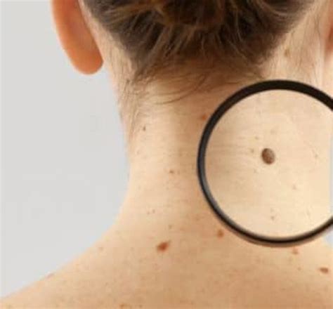 Skin Lesion Excision Consultant Anca Breahna Plastic Surgeon