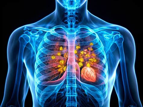 Thoracic Ct Scan Reveals Lung Disease Lymph Node Involvement And Potential Chest Cavity Tumor