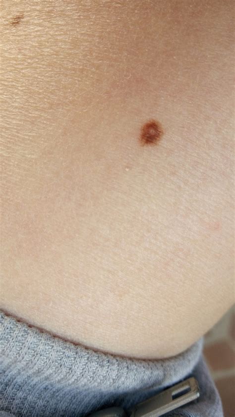 Родинка на ноге Вопрос онкологу 03 Онлайн