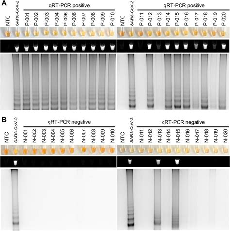 Detection Of Sars Cov 2 With Rt Lamp In Patient Nasopharyngeal Swab Download Scientific Diagram