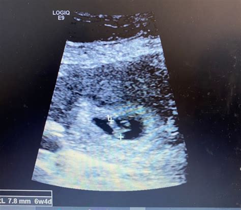 7 Week Ultrasound