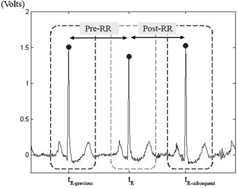 Ecg Arrhythmia Classification Using Time Frequency Distribution Techniques Pmc