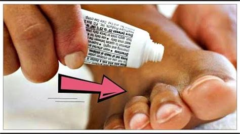 Не кормите АПТЕКИ От грибка на коже и ногтях поможет КОПЕЕЧНОЕ средство