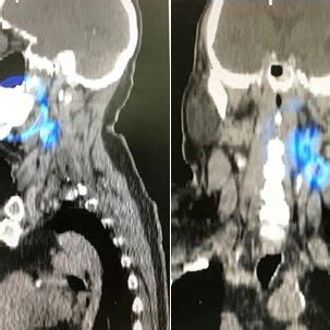 Sentinel Lymph Node With Accumulated Radiopharmaceutical Download Scientific Diagram