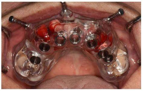 Prosthesis An Open Access Journal From Mdpi