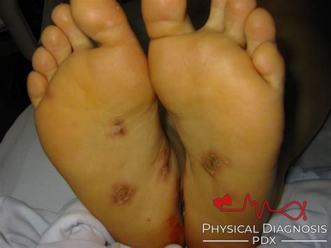 Syphilis Rash On Sole Of Foot Factory Sale