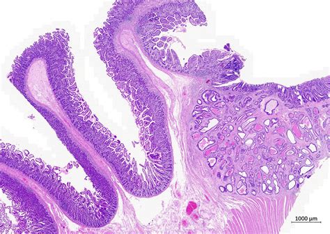 Adenocarcinoma Of The Oral Jejunum Intestinal Type Right Intestinal