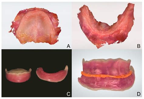 Digital Workflow To Fabricate Complete Dentures For Edentulous Patients