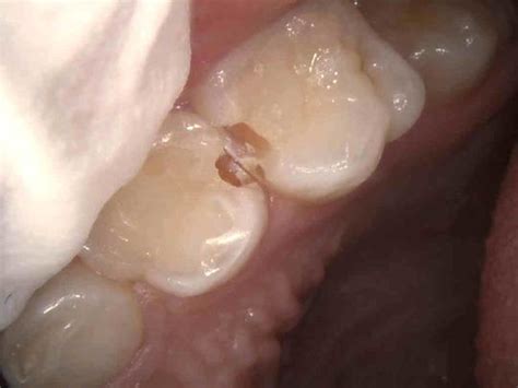 Dental Anomaly Detection Object Detection Dataset By Wei Jie