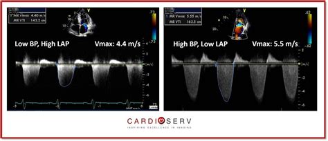 3 Doppler Techniques For Evaluation Of Mr Cardioserv