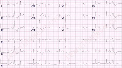 Premature Ventricular Contractions Pvcs With Echo Beats Ecg