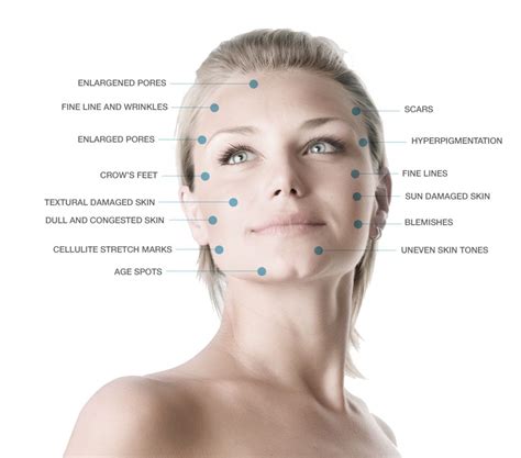 Microderm Face Map At Maria Cardenas Blog