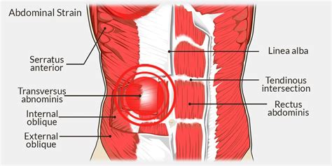 Abdominal Strain The Complete Injury Guide Vive Health