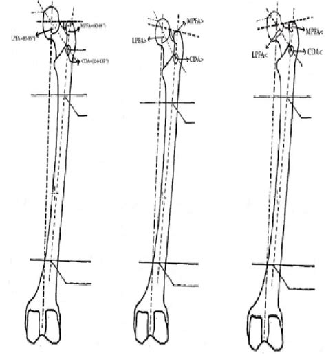 Figure 1 From Morphometric Parameters Of The Proximal Femoral Epiphysis And Their Effect On The